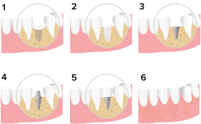 Stages of implantation - Dentalcrack